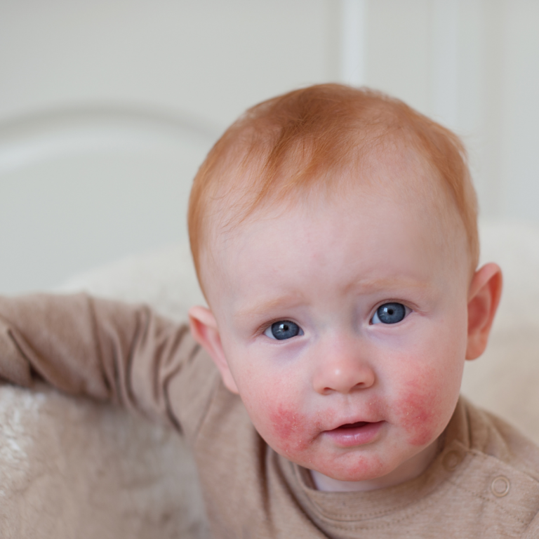 Como saber se é dermatite atópica? Dermatologia pediatrica